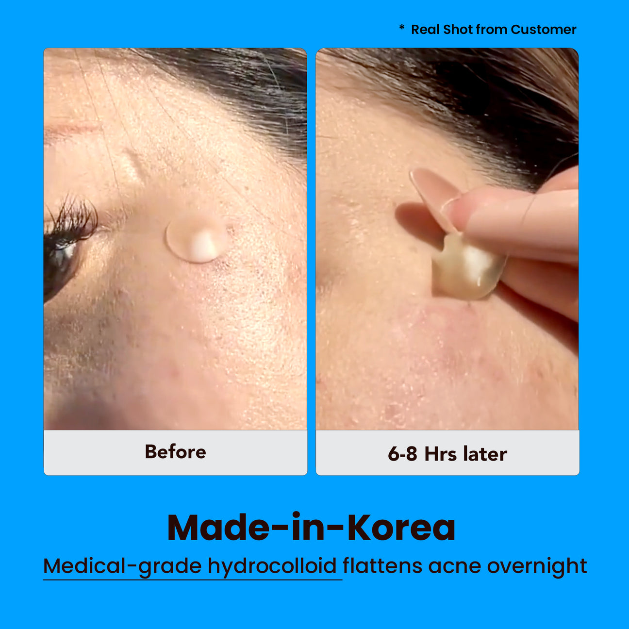 Acne Cover Patch Original 40CT (Size: Medium 10 - 14mm) for Pimple | V ...