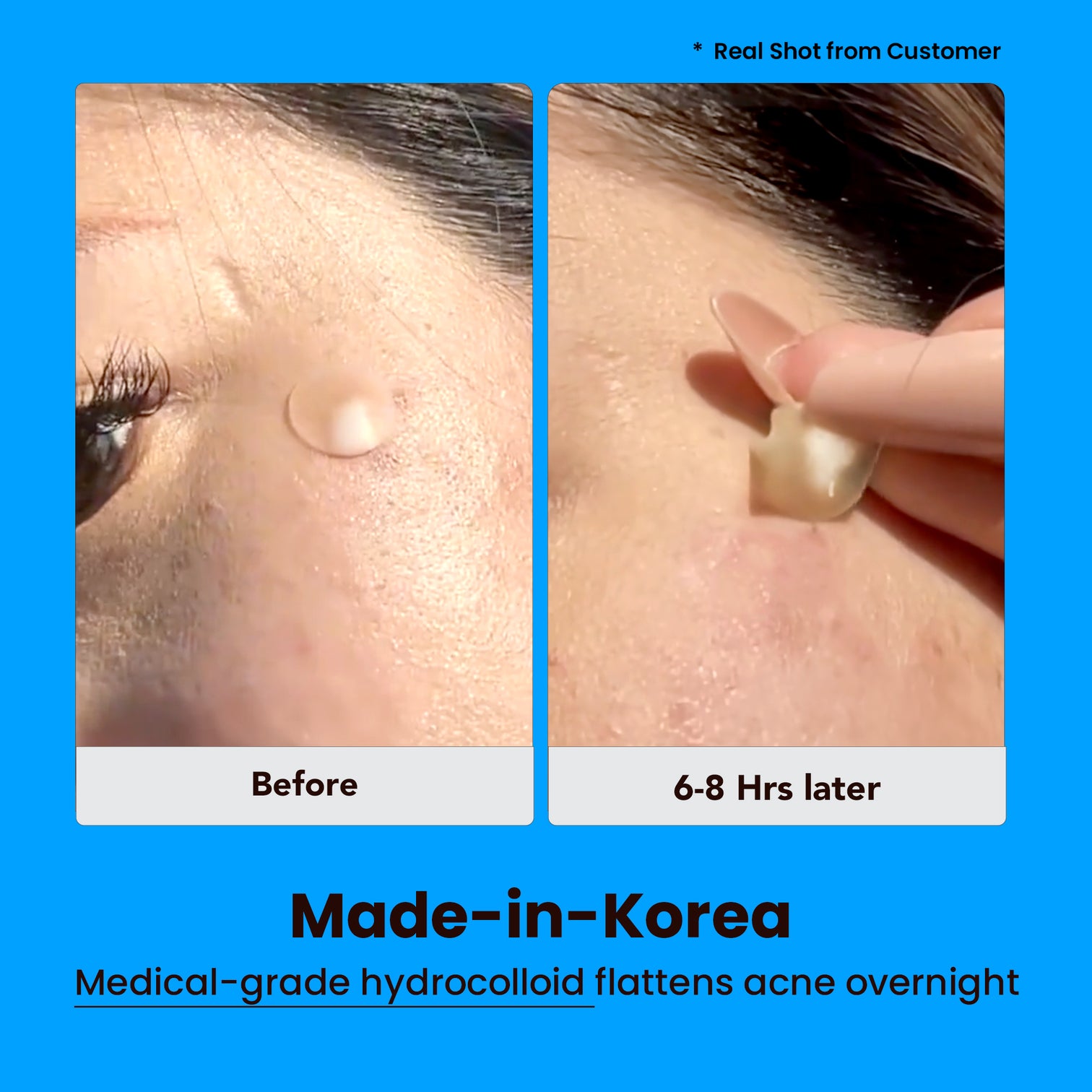 Acne Cover Patch Original 40CT (Size: Medium 10 - 14mm) for Pimple | V ...